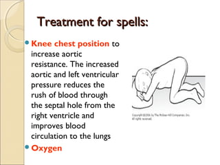Knee Chest Position Tetralogy Fallot