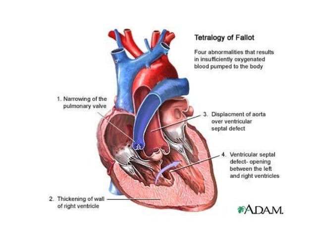 Tetralogy of fallot