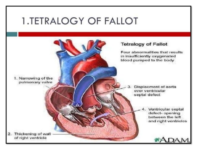 Tetralogy of fallot