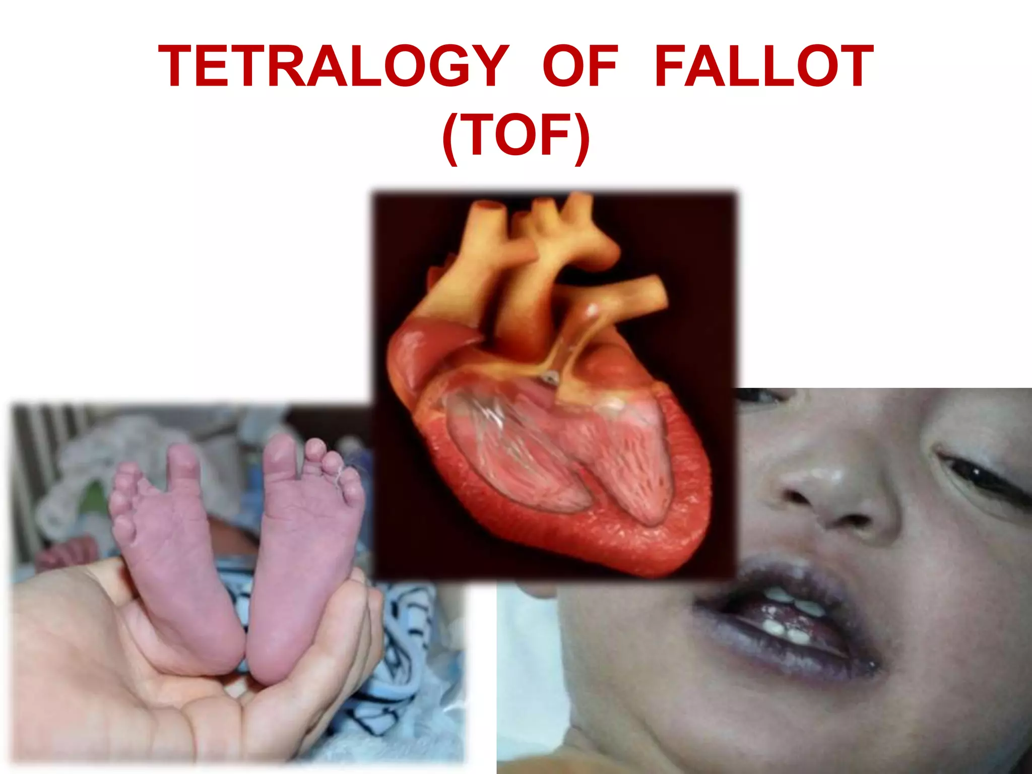 Tetralogy of fallot | PPTX