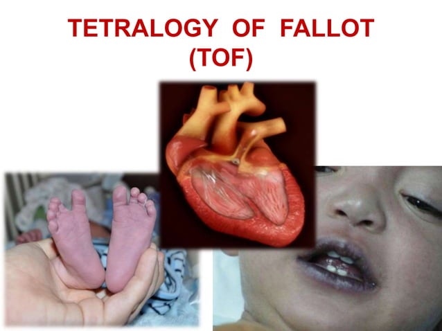 Tetralogy of fallot | PPTX | Heart and Cardiovascular Diseases ...