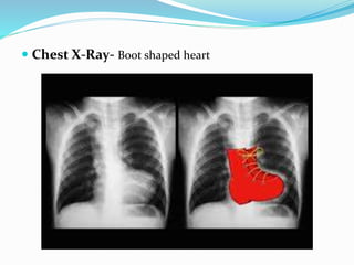 Tetralogy of fallot | PPTX