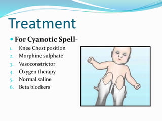 Knee Chest Position Tetralogy Fallot