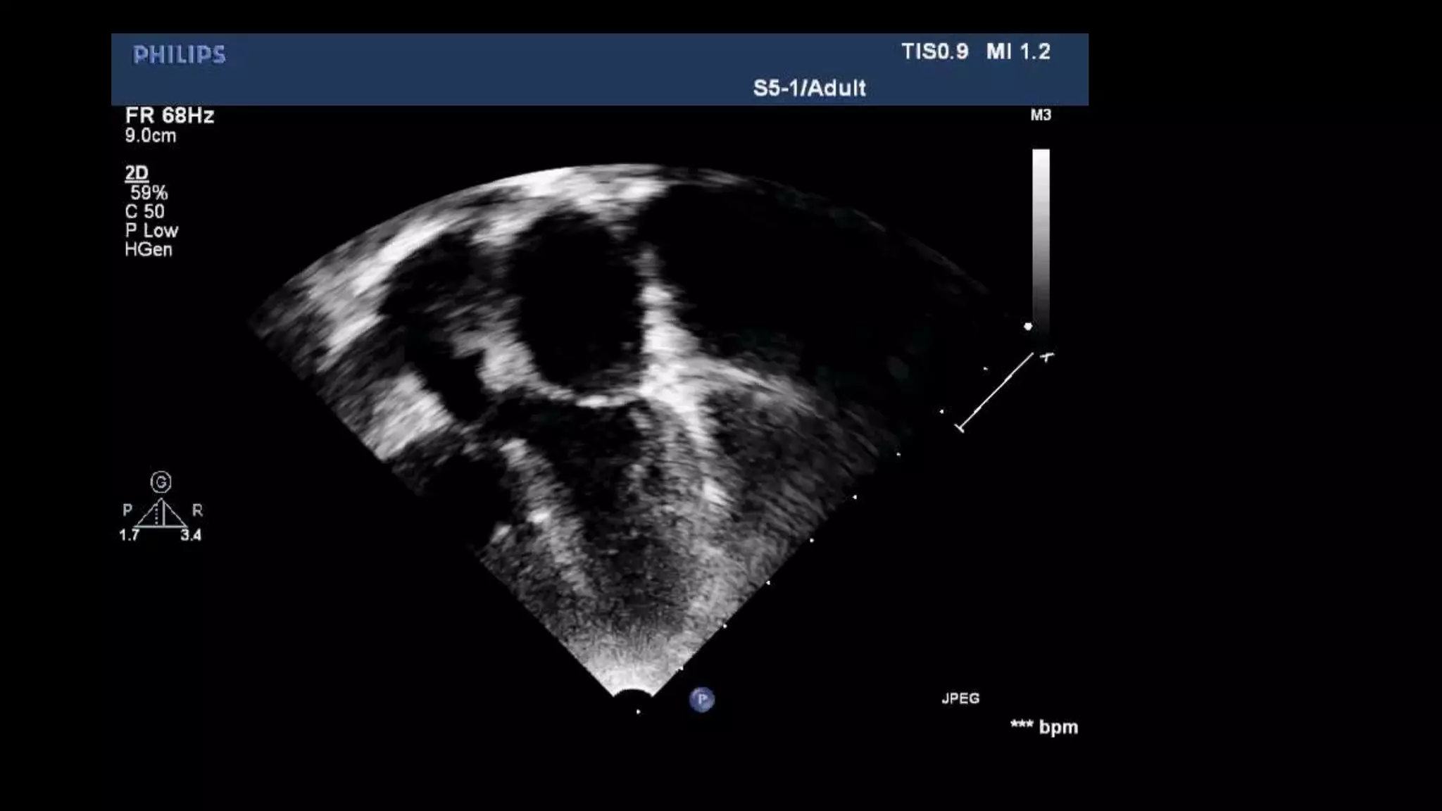 Tetralogy of Fallot.pptx