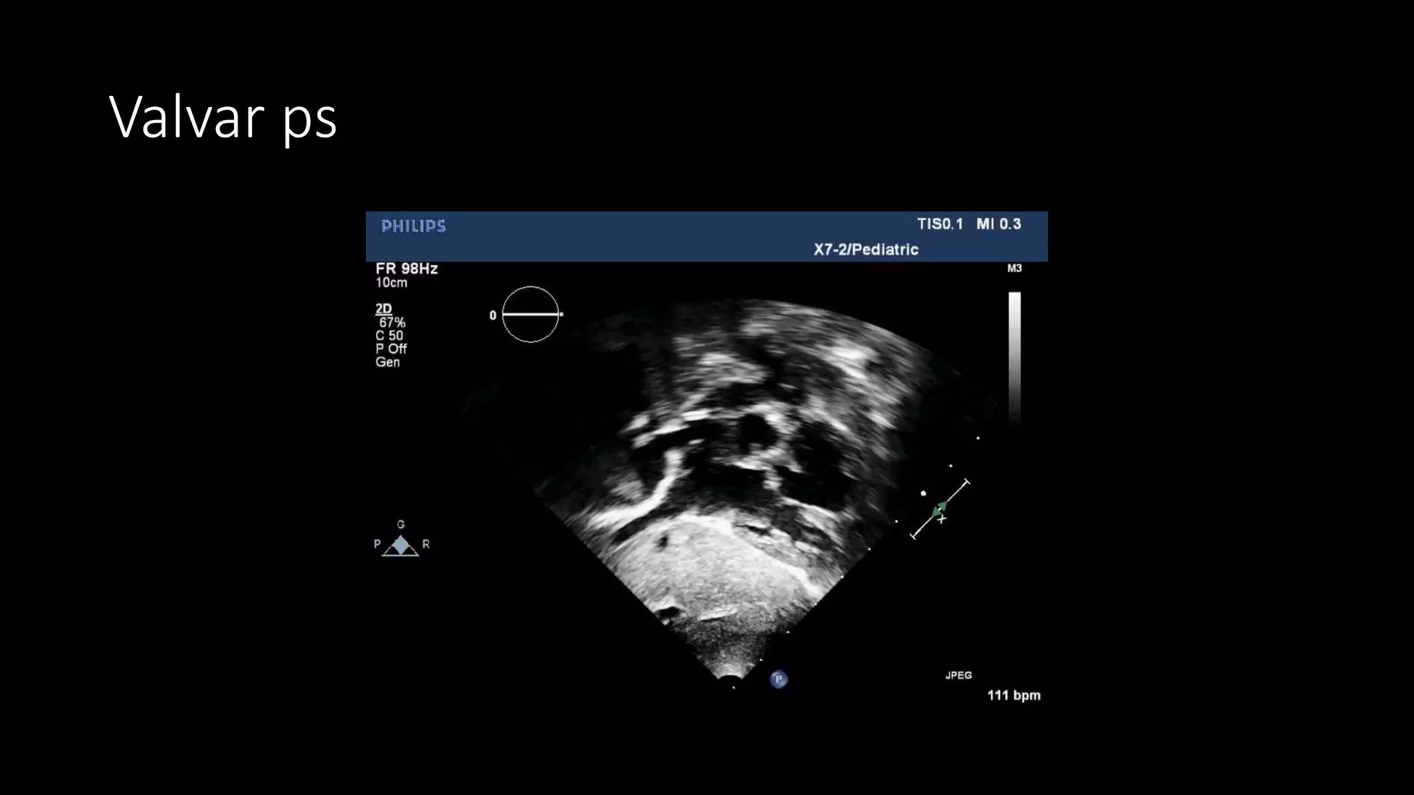Tetralogy of Fallot.pptx