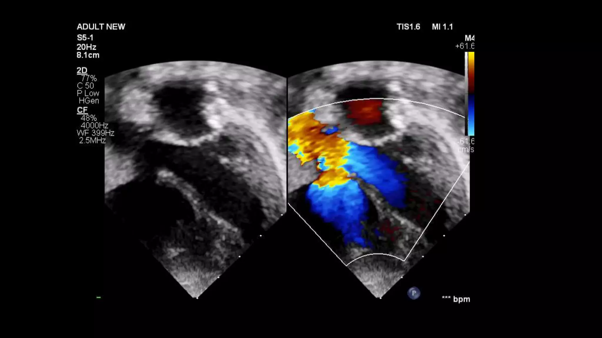Tetralogy of Fallot.pptx