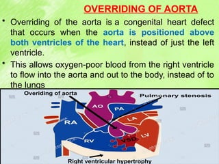 tetralogy of fallot/TOF .pptx
