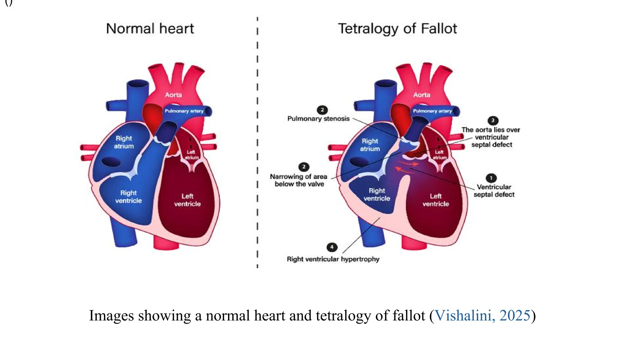 Tetralogy of Fallot,Fallot's syndrome, Fallot's tetrad, Steno–Fallot ...