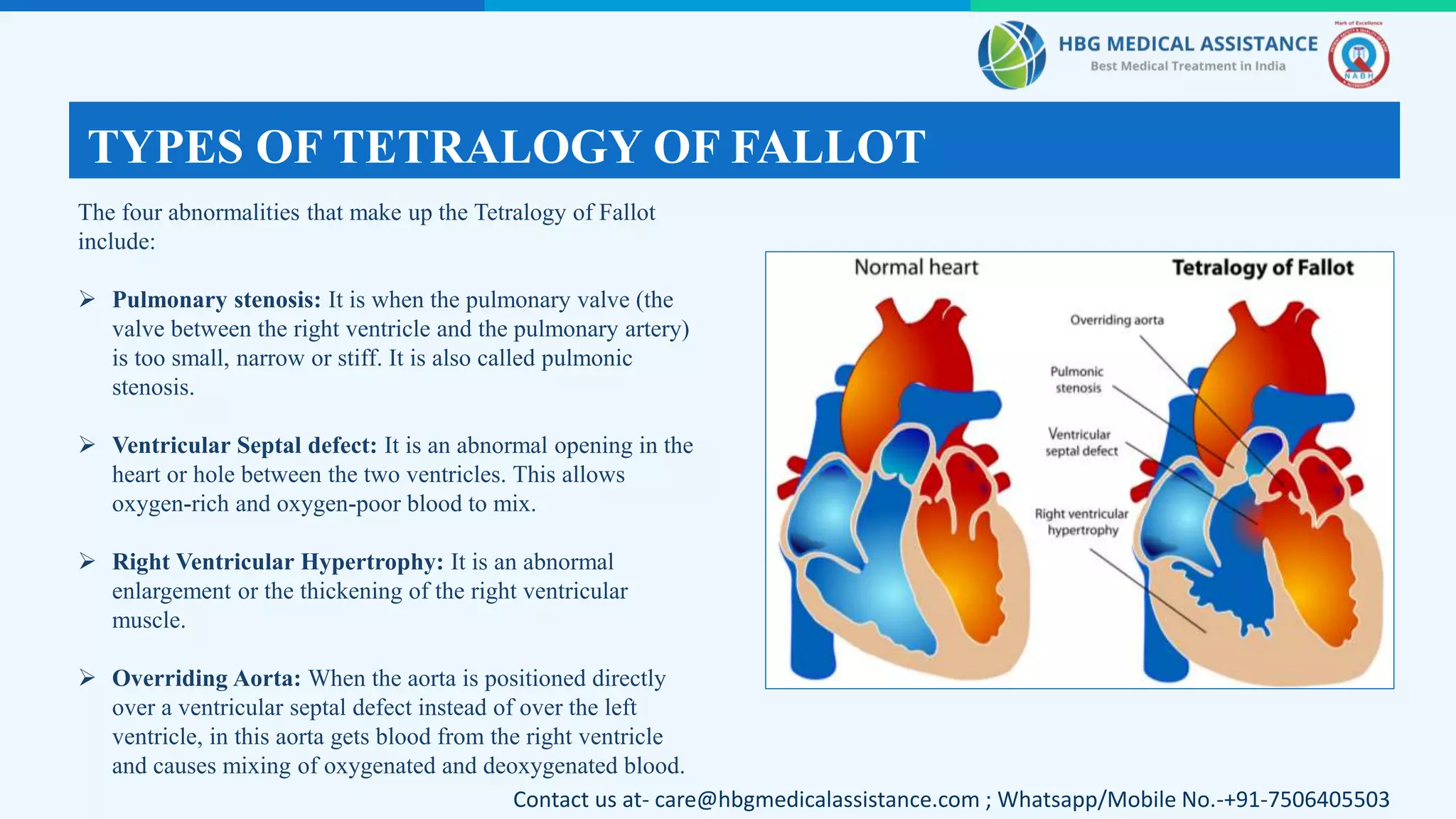 Best Tetralogy of Fallot surgery in India, TOF surgery in India | PPT