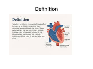 Tetralogy_of_Fallot_Presentation_Azumi_with_Definition.pptx