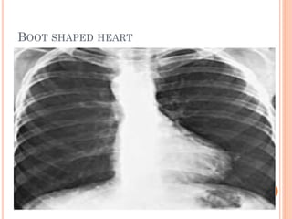 Tetralogy of falot management | PPT