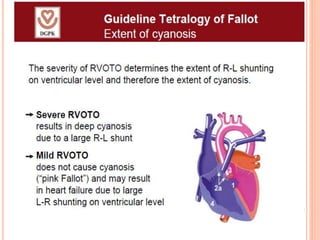 Tetralogy of falot management | PDF