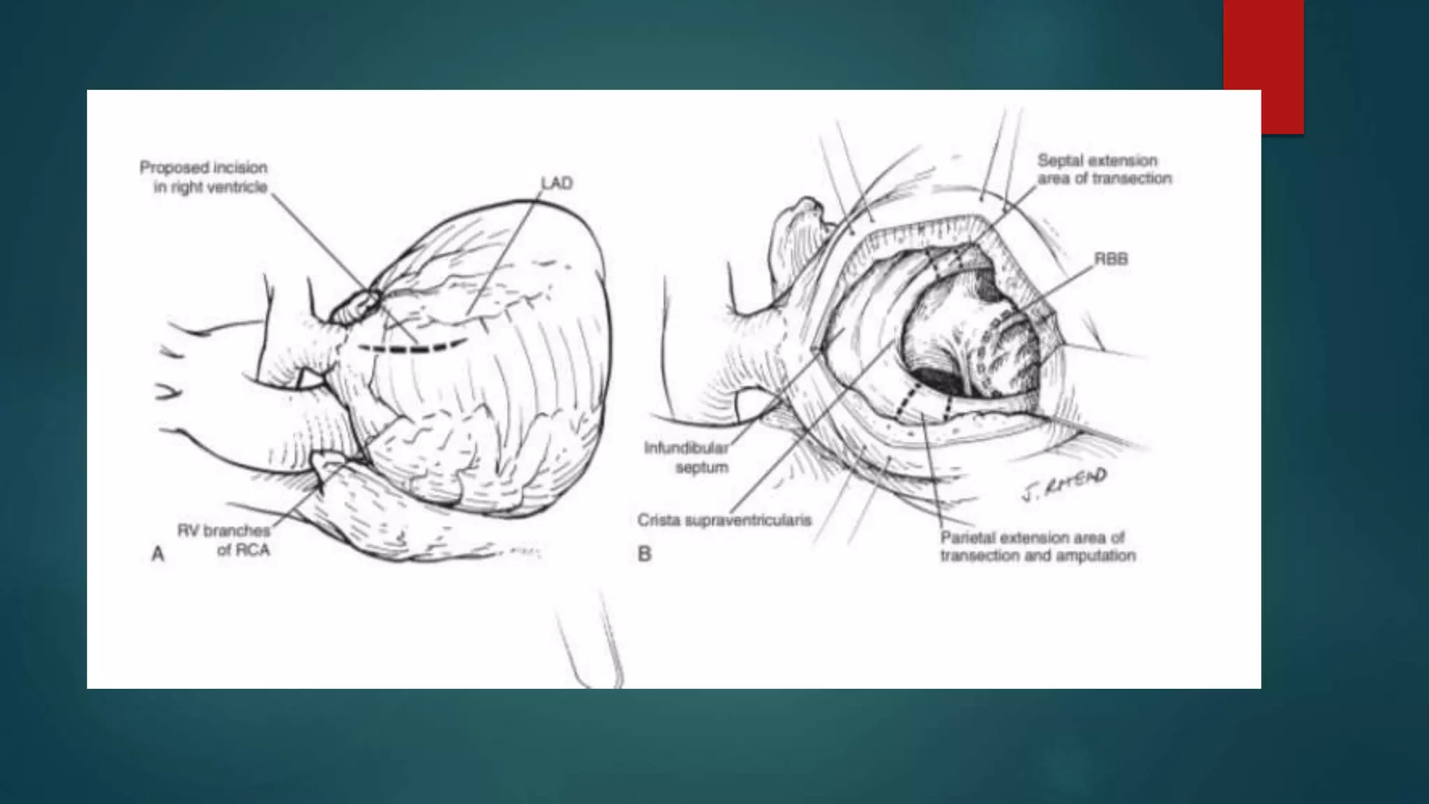 Tetrology of fallot corrective surgeries | PPTX | Heart and ...
