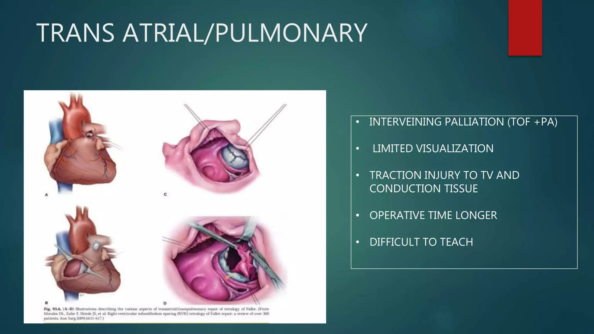 Tetrology of fallot corrective surgeries | PPTX | Heart and ...