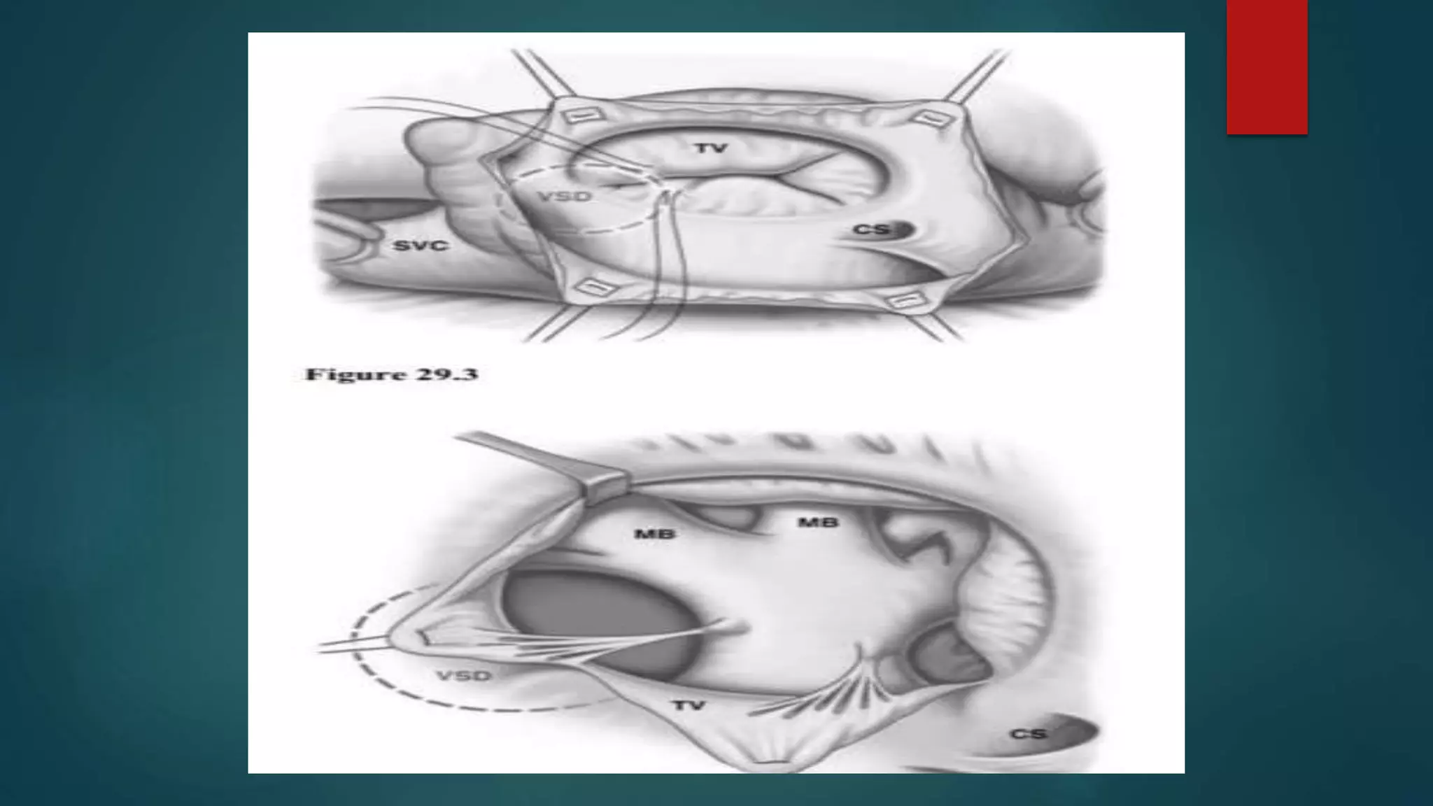 Tetrology of fallot corrective surgeries | PPTX | Heart and ...