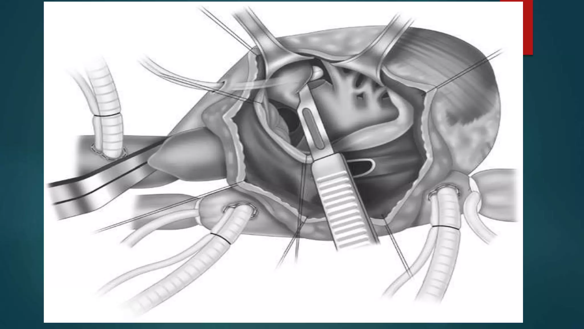 Tetrology of fallot corrective surgeries | PPTX | Heart and ...