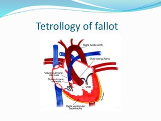 mangement of Tet spells | PPTX
