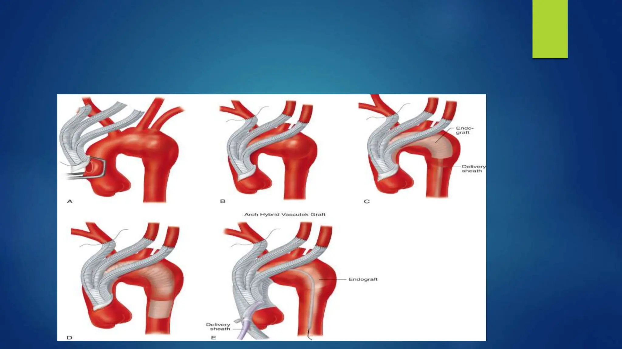 TEVAR.pptx