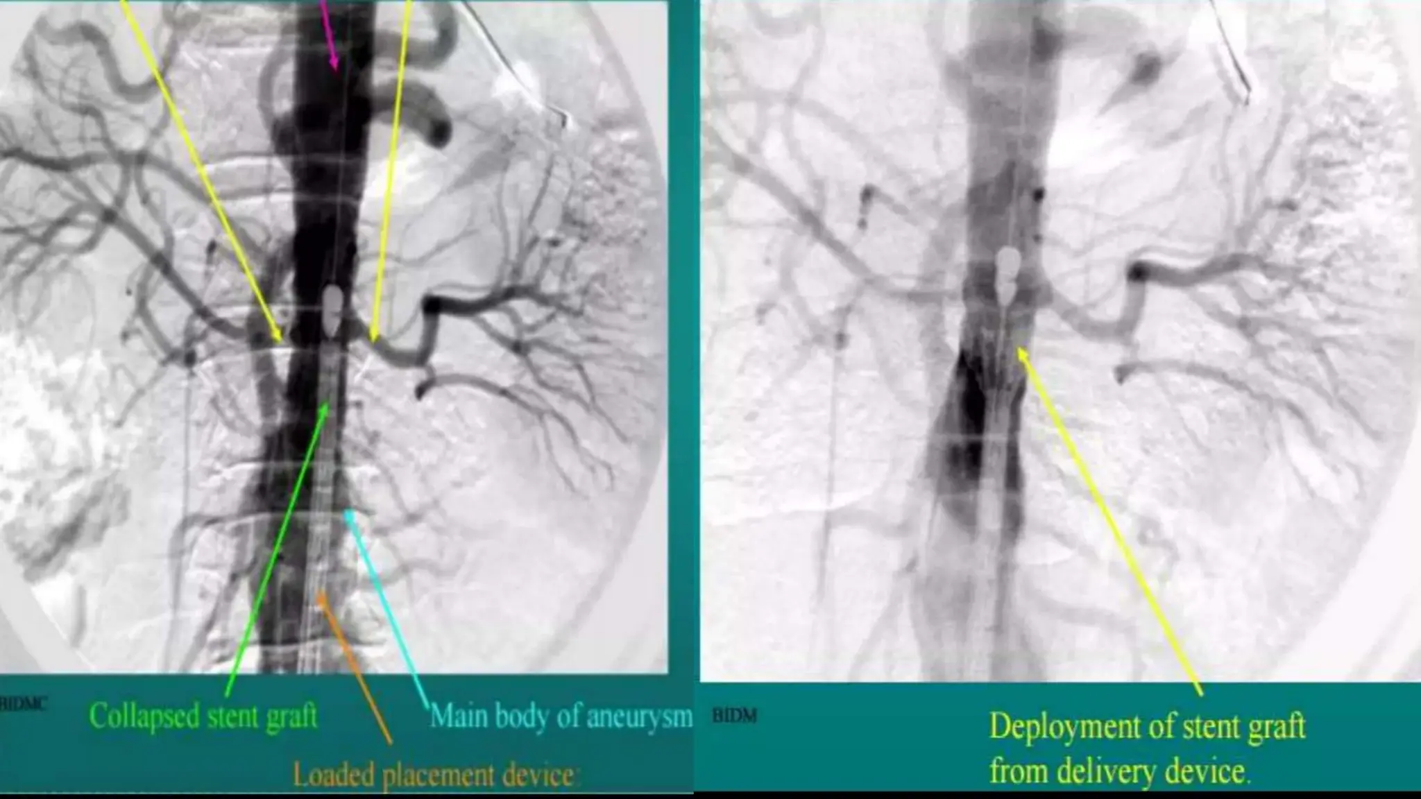 Tevar & evar ppt by Dr. Amrit kumar CTVS | PPTX