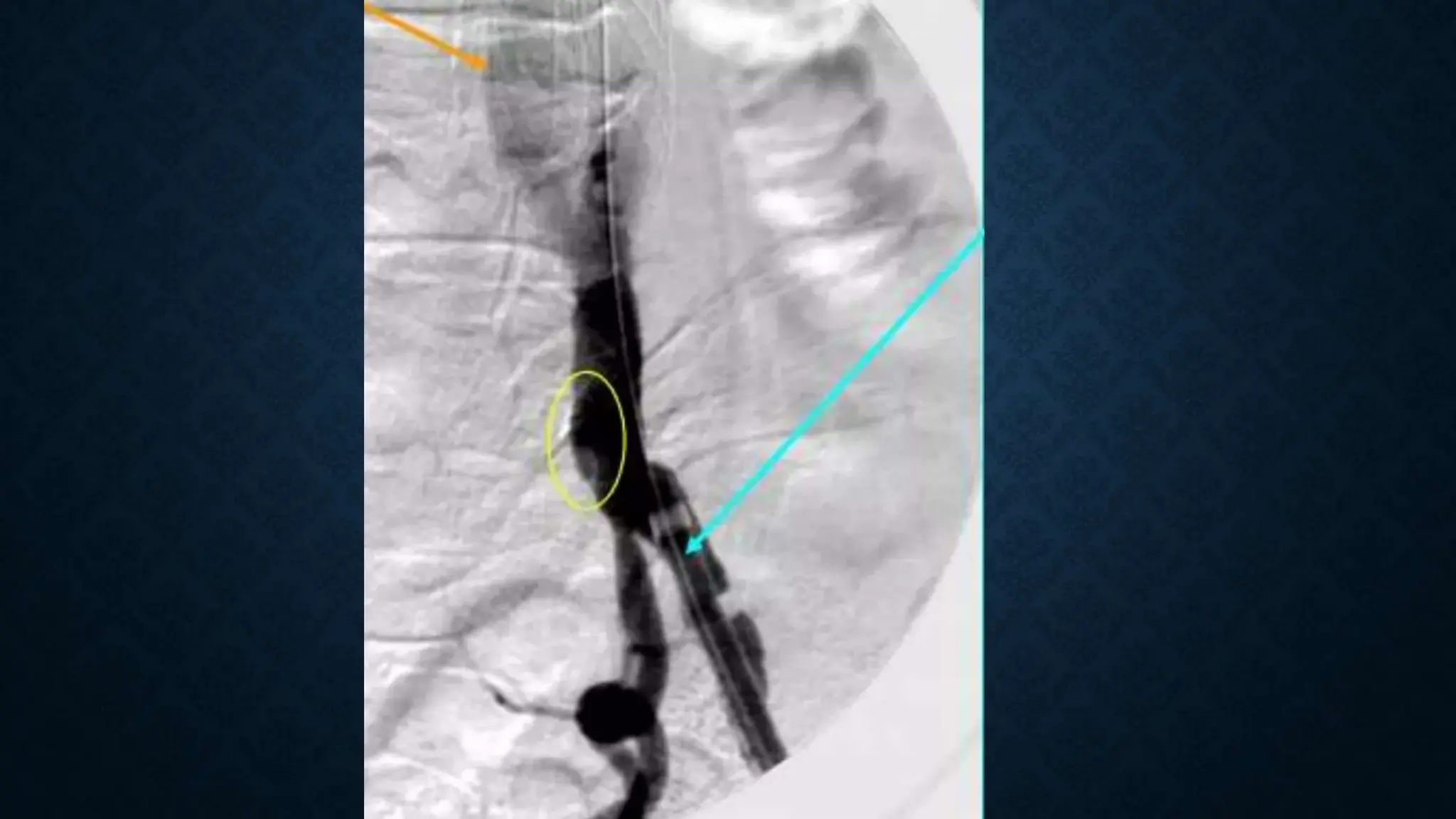 Tevar & evar ppt by Dr. Amrit kumar CTVS | PPTX