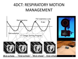 RECENT ADVANCES IN BREAST CANCER RADIOTHERAPY | PPTX
