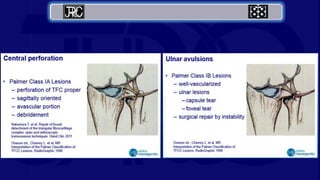 TFCC (Triangular fibro cartilage complex) Injury | PPT