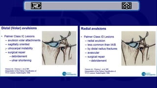 TFCC (Triangular fibro cartilage complex) Injury | PPT