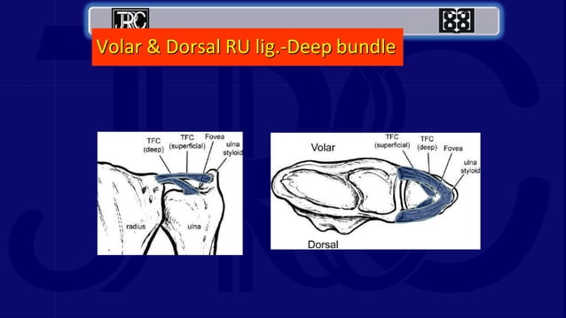TFCC (Triangular fibro cartilage complex) Injury | PPT