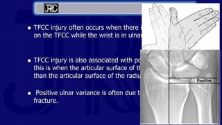 TFCC (Triangular fibro cartilage complex) Injury | PPT