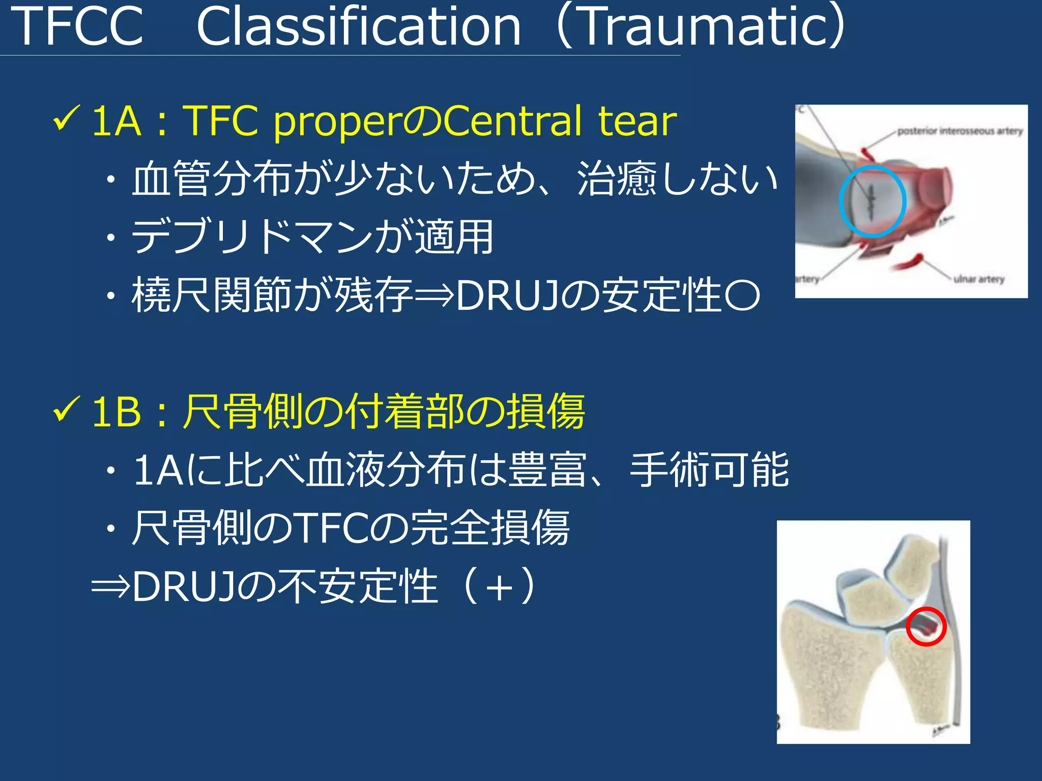DRUJ(遠位橈尺関節)の不安定性とTFCC(三角線維軟骨複合体)損傷に関する文献まとめ | PPTX