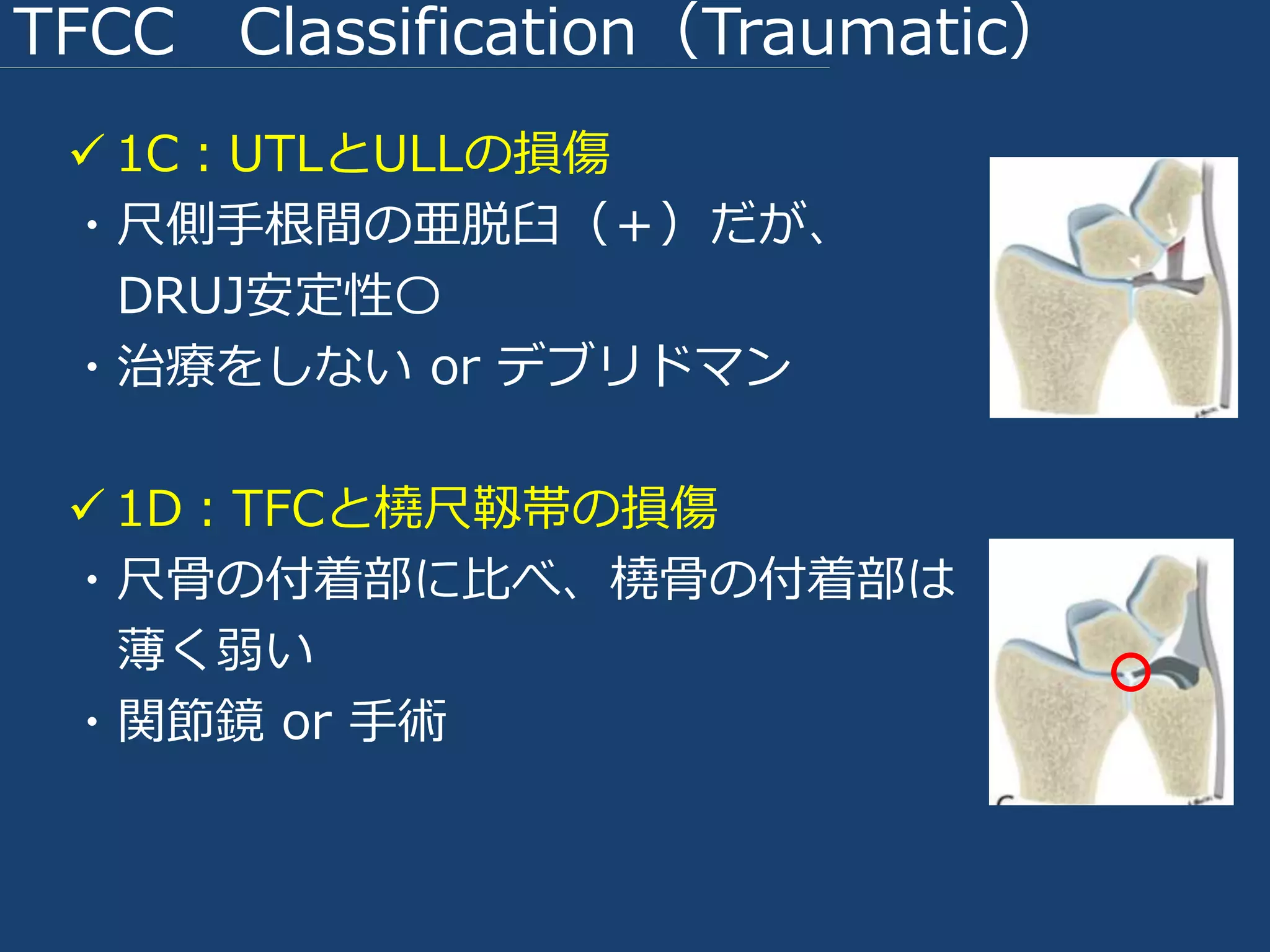 DRUJ(遠位橈尺関節)の不安定性とTFCC(三角線維軟骨複合体)損傷に関する文献まとめ | PPTX