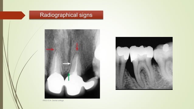 Trauma from occlusion (Including TFO around dental implants) | PPTX
