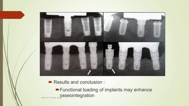 Trauma from occlusion (Including TFO around dental implants) | PPTX