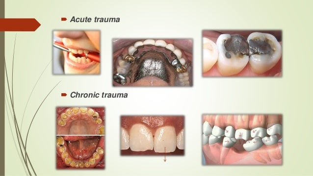 Trauma from occlusion (Including TFO around dental implants)
