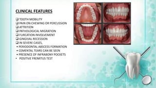 Trauma from Occulsion in periodontology.pptx