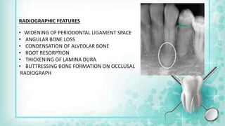 Trauma from Occulsion in periodontology.pptx