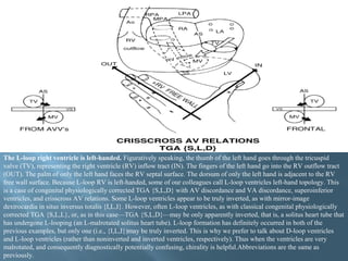 Transposition of Great Arteries;TGA,Firas Aljanadi,MD | PPT