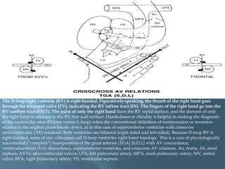 Transposition of Great Arteries;TGA,Firas Aljanadi,MD | PPT