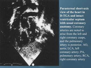 Transposition of Great Arteries;TGA,Firas Aljanadi,MD | PPT
