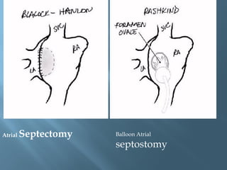 Transposition of Great Arteries;TGA,Firas Aljanadi,MD | PPT