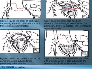 Transposition of Great Arteries;TGA,Firas Aljanadi,MD | PPT