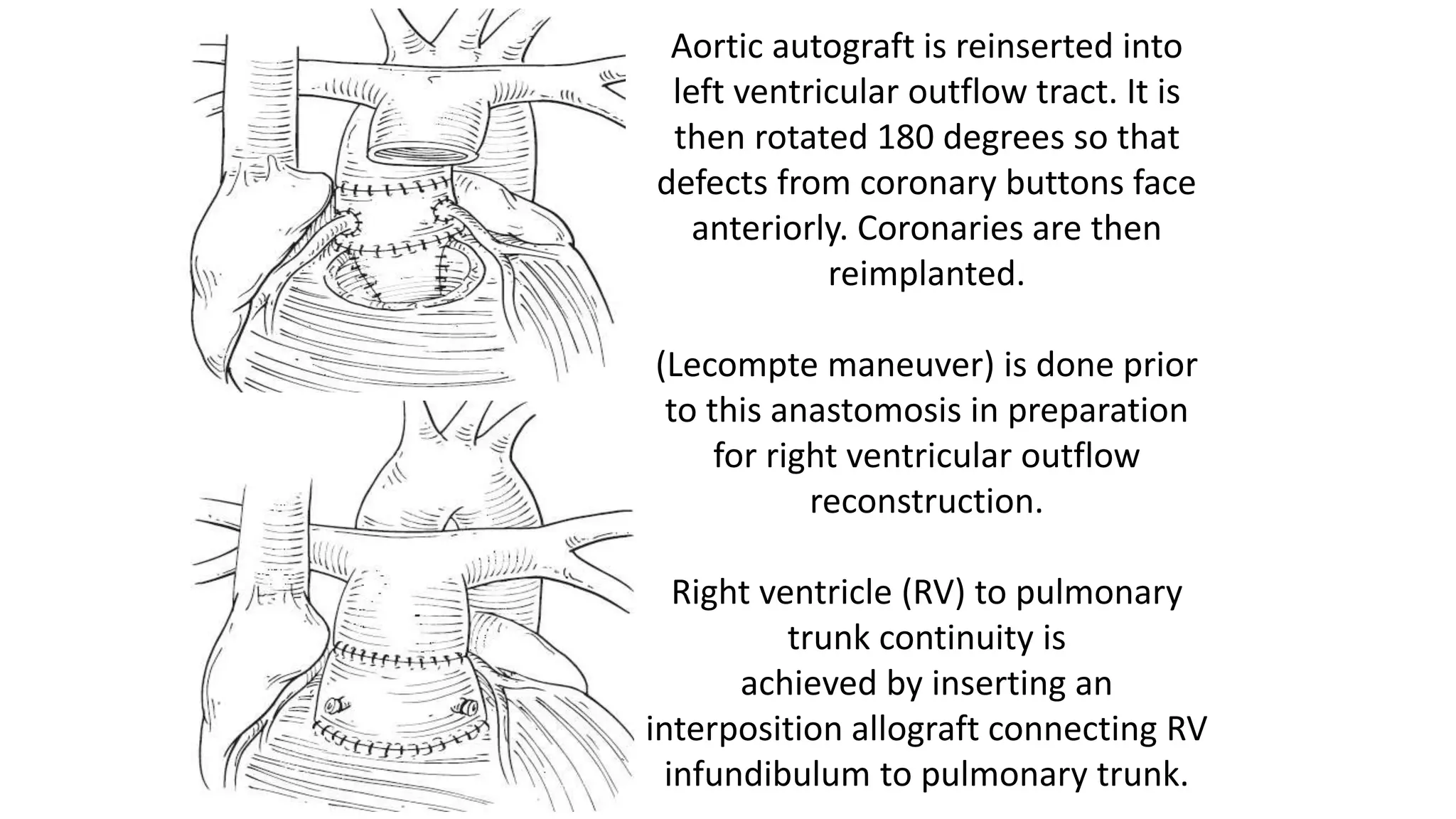 Transposition of great arteries with lvoto management | PPTX