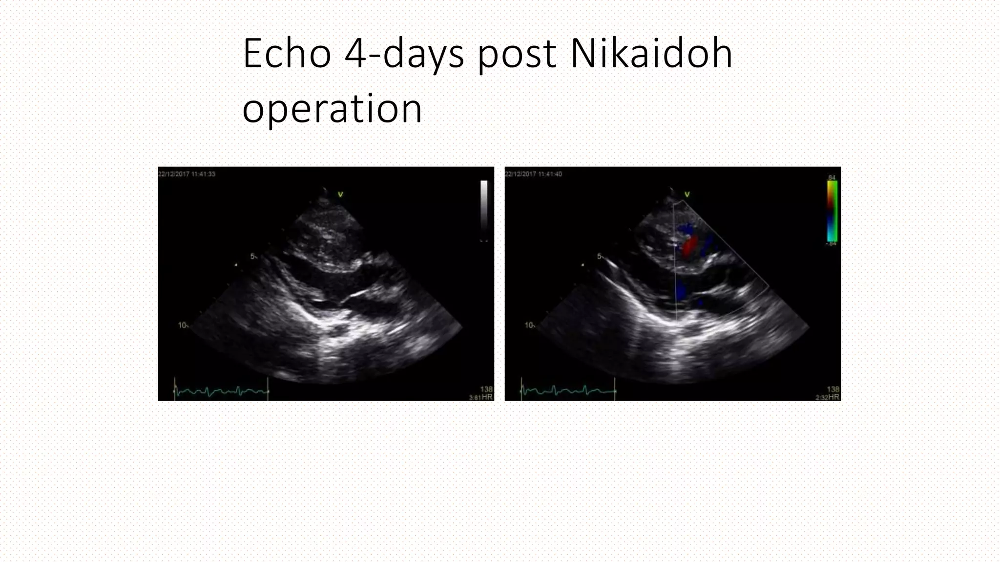 Transposition of great arteries with lvoto management | PPT