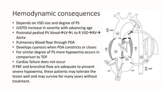 Transposition of great arteries with lvoto management | PPTX