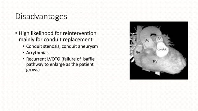 Transposition of great arteries with lvoto management | PPTX