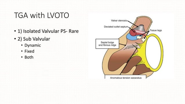 Transposition of great arteries with lvoto management | PPTX