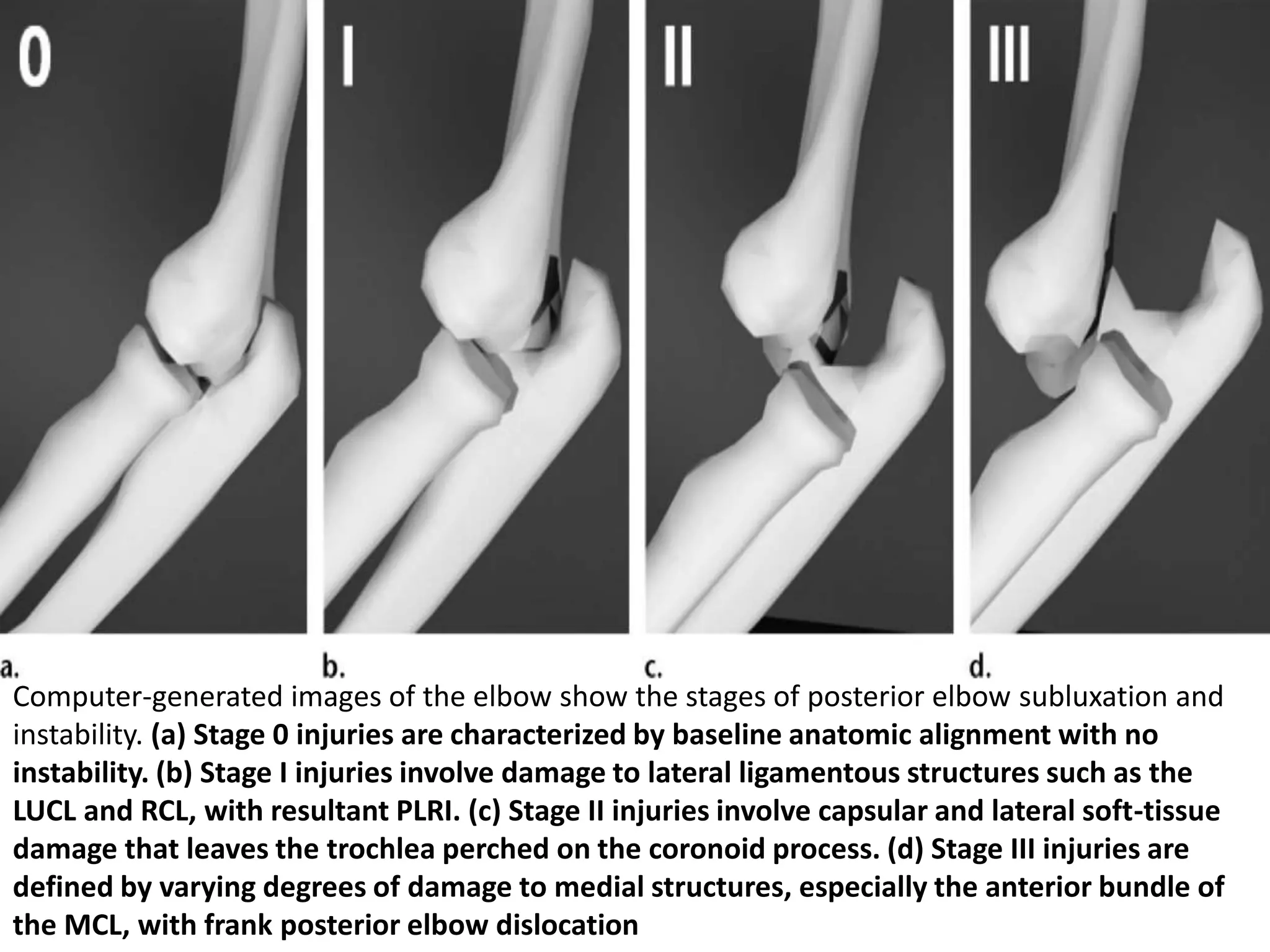 Elbow injury | PPTX