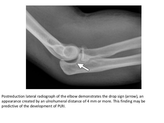 Elbow injury