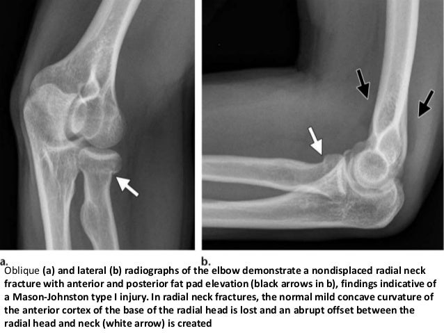 Elbow injury