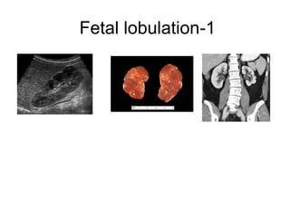 Congenital lesions and variants of renal system | PPT